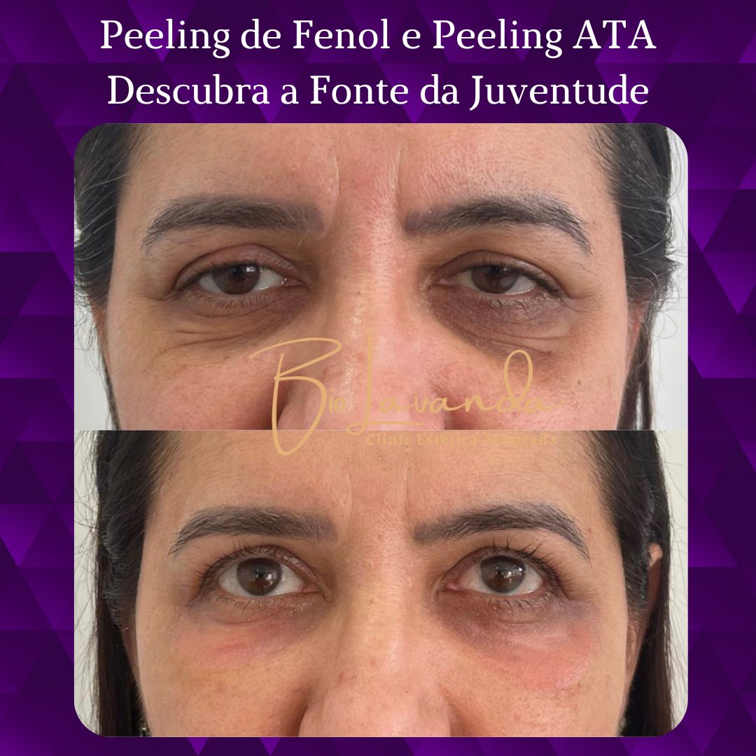 peeling-de-fenol – Bio Lavanda Clinic