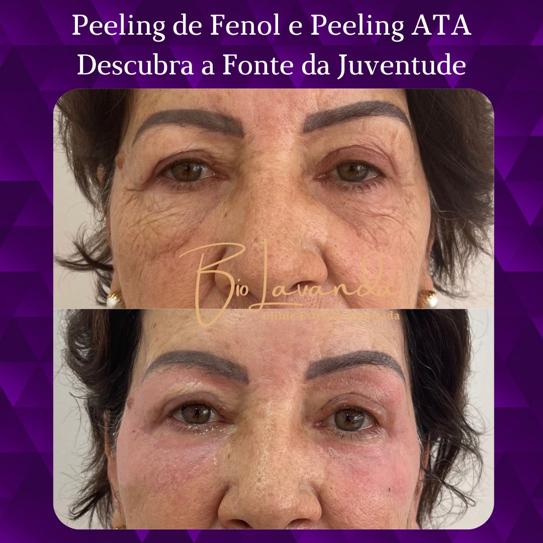 peeling-de-fenol – Bio Lavanda Clinic