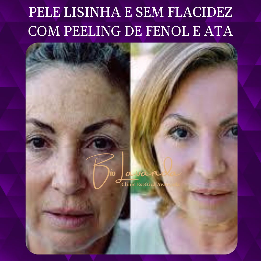 peeling-de-fenol – Bio Lavanda Clinic